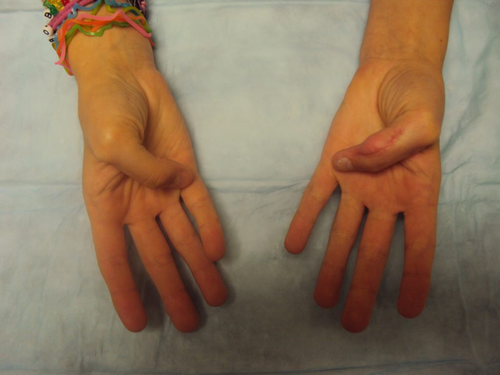Thumb Duplication - Hand and Wrist Surgery - Cypress, Tomball, Katy ...