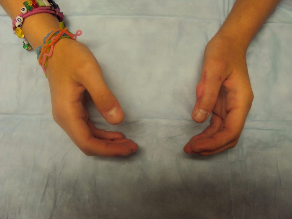 Thumb Duplication - Hand and Wrist Surgery - Cypress, Tomball, Katy ...