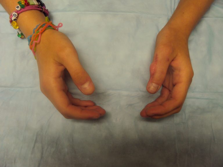 Thumb Duplication - Hand and Wrist Surgery - Cypress, Tomball, Katy ...
